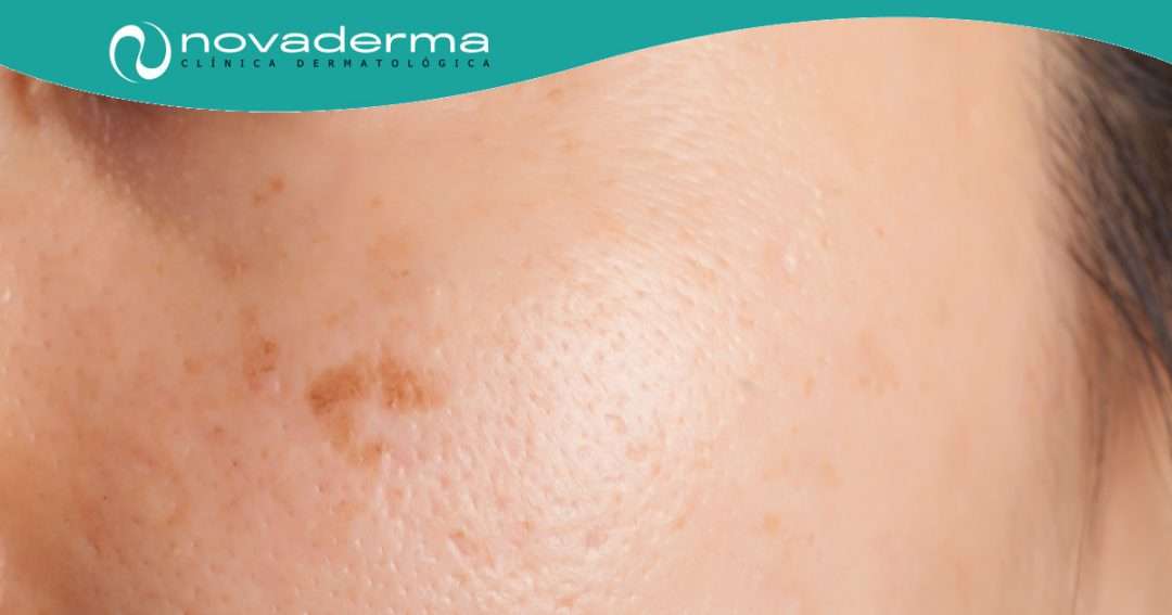 Todo lo que debes saber sobre el melasma - Clínica Dermatológica ...