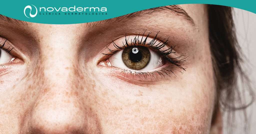 Manchas en la piel, ¿cómo saber que se trata de Mastocitosis? - Clínica ...