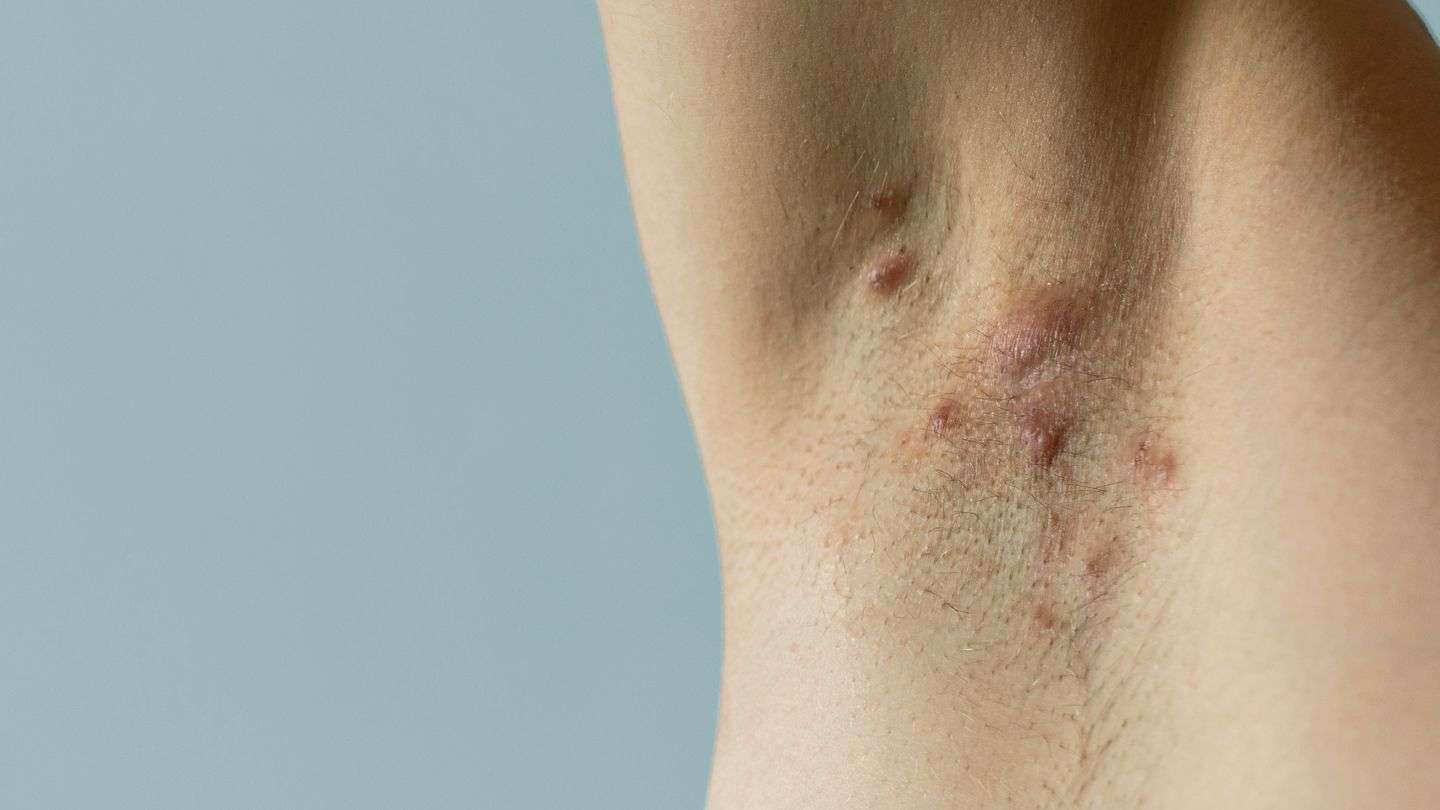 Tratamiento de hidrosadenitis - Clínica Dermatológica Novaderma ...