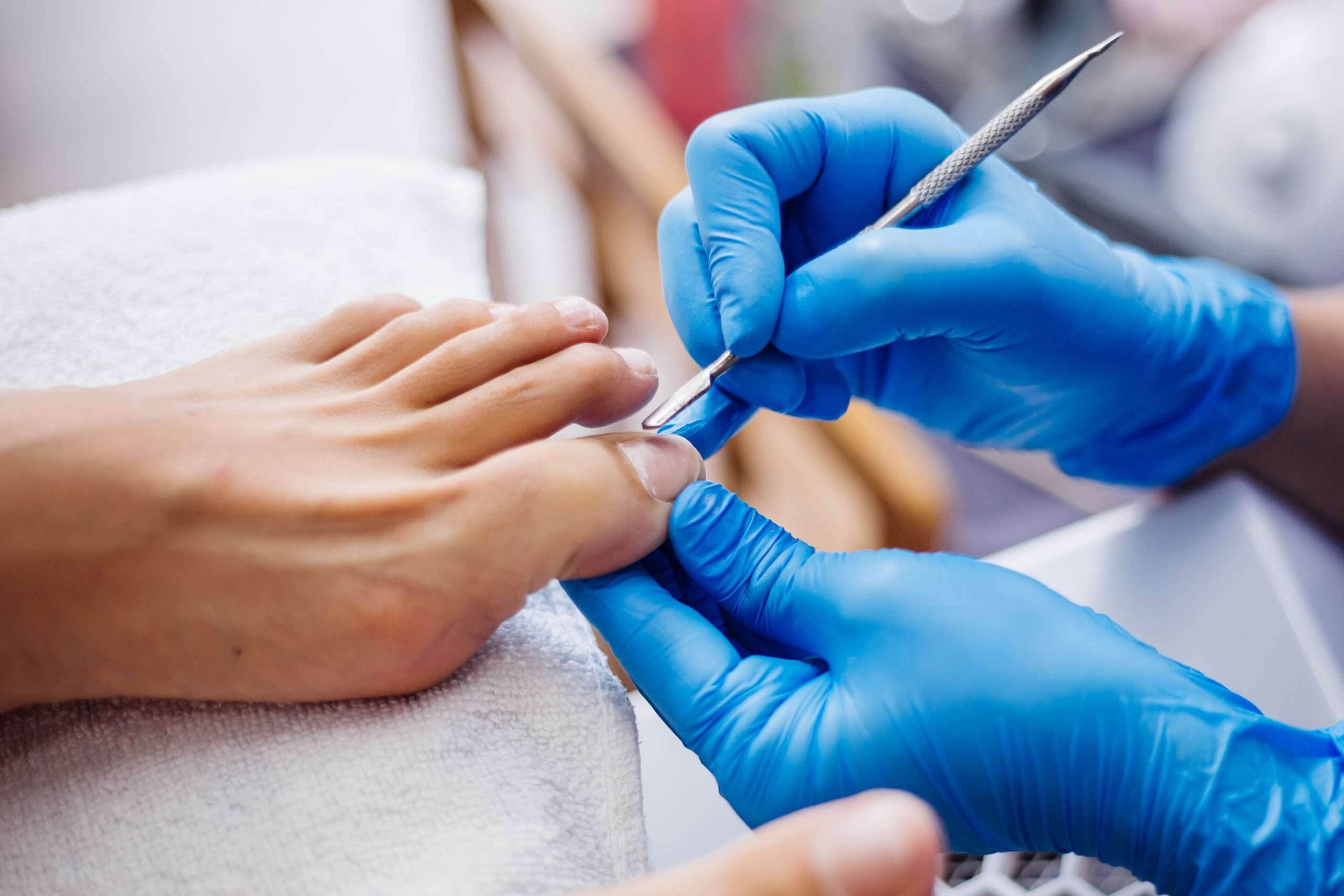 Tratamiento de uñas encarnadas - Clínica Dermatológica Novaderma ...